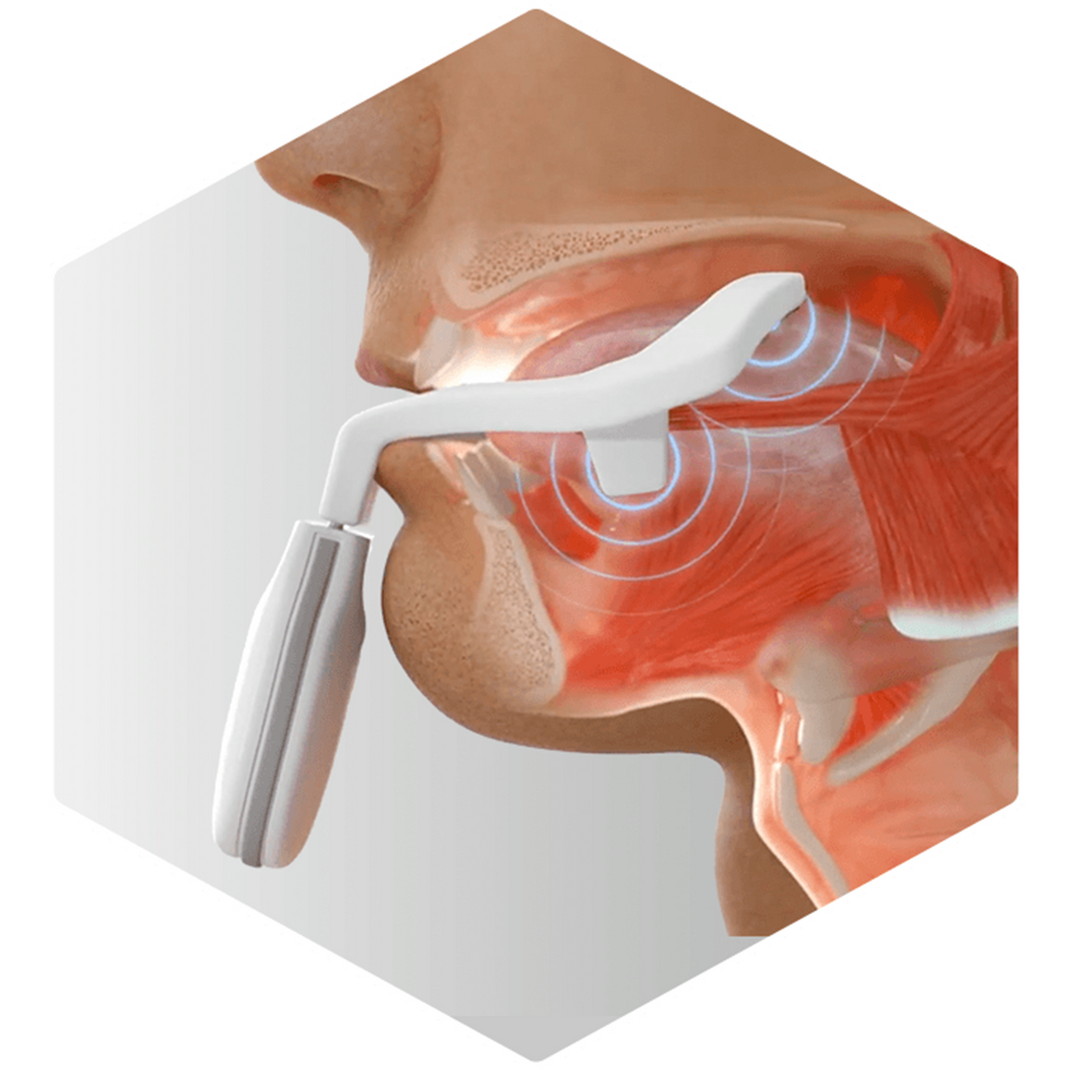 exciteOSA Tongue Stimulator for Sleep Apnea
